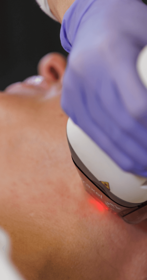 Rejuvenate Your Skin with Fraxel in Murfreesboro, TN | Near you!